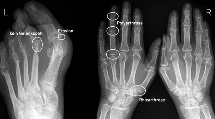 Rheumatoide Arthritis auf Röntgenbildern erkennen. Ein Leitfaden für ...